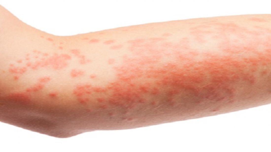 ‫جندوبة : غلق مدرسة إعدادية بسبب انتشار مرض الطفح الجلدي